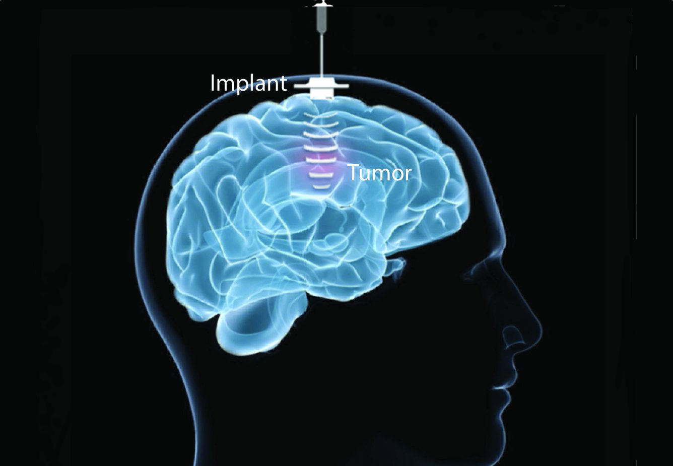 CarThera amorce sa série B | CFNEWS